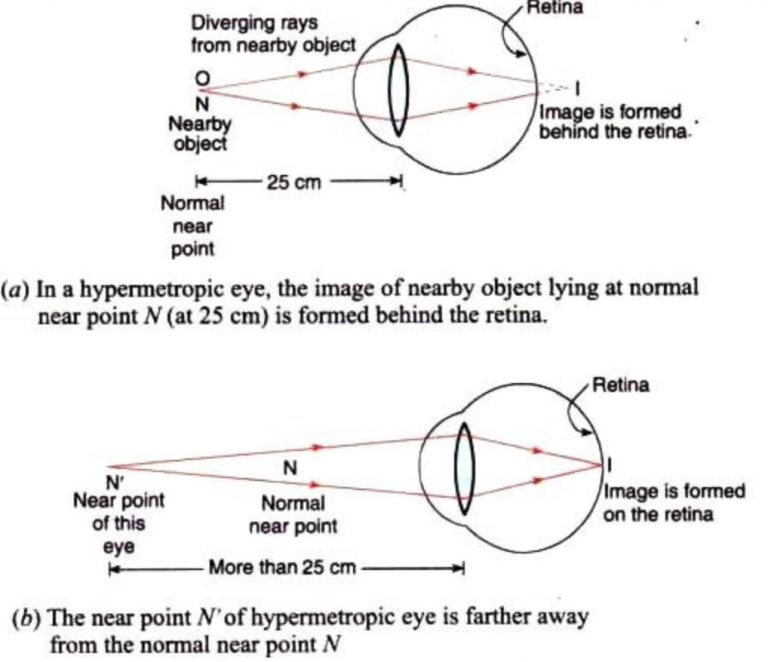 Defects of Vision and their Correction - Class 10, The Human Eyes and ...