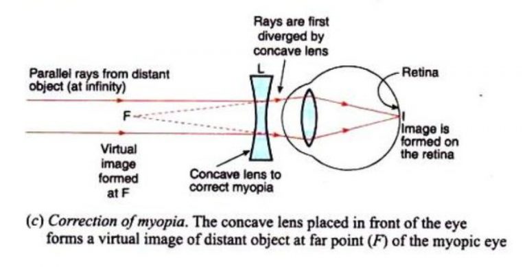 Defects of Vision and their Correction - Class 10, The Human Eyes and ...